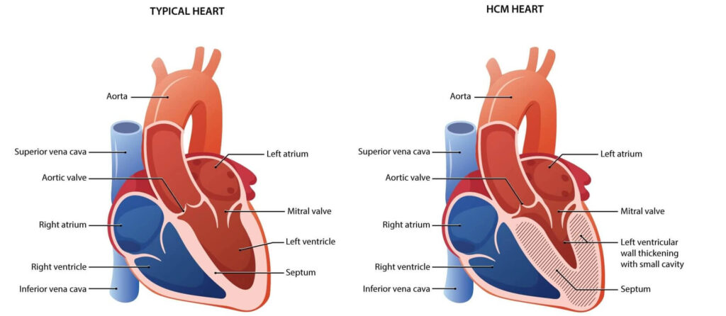 About Hypertrophic Cardiomyopathy (HCM) - Tenaya Therapeutics